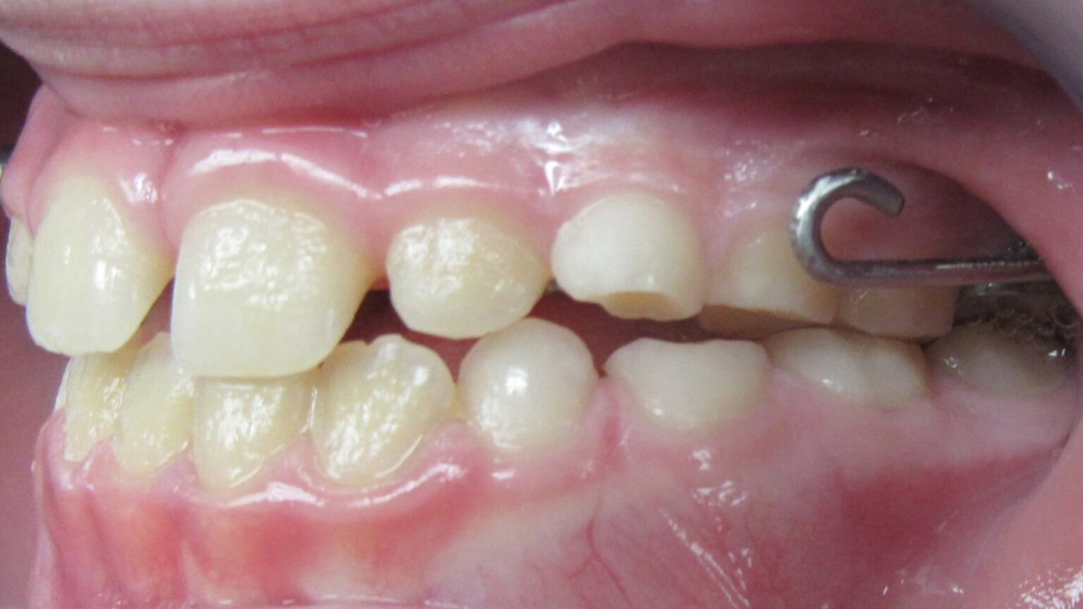 The Power of Growth Modification in Orthodontics - Dubuque Ortho