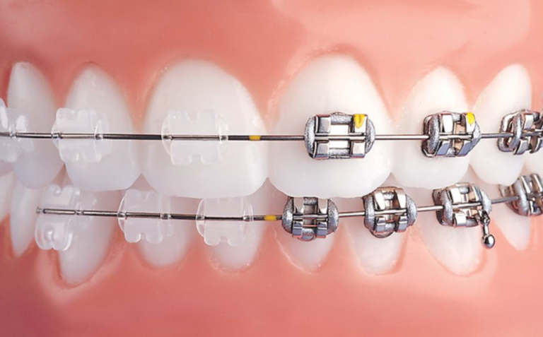 metal ceramic braces - Dubuque Ortho